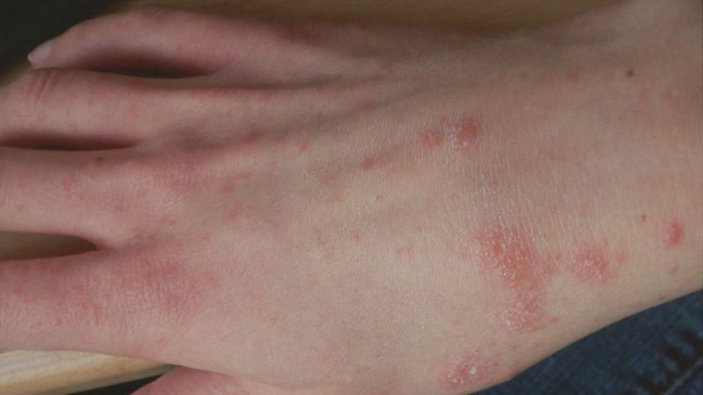 Scabies Photos and Symptoms - Sitio.media